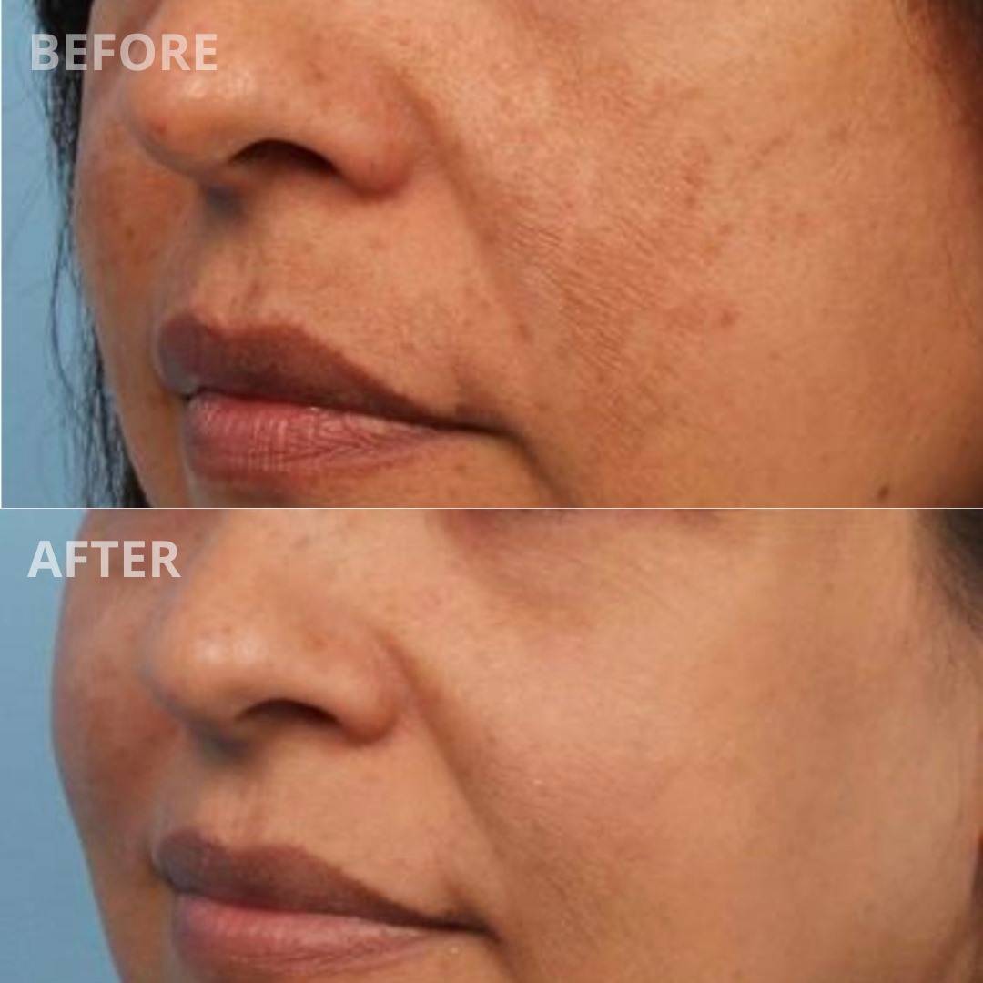 Hollywood Laser Rejuvenation & Scar Treatment - Bombshell Aesthetic Lounge